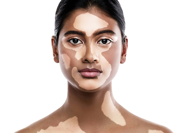 Vitiligo Treatment in Hyderabad | Experts Skin & Hair Clinic